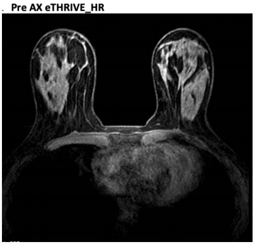 MR Bilateral Breasts WWO Protocol | OHSU